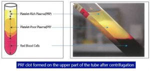 Dental Use PRF CGF Centrifuge for Sale | KETHINK